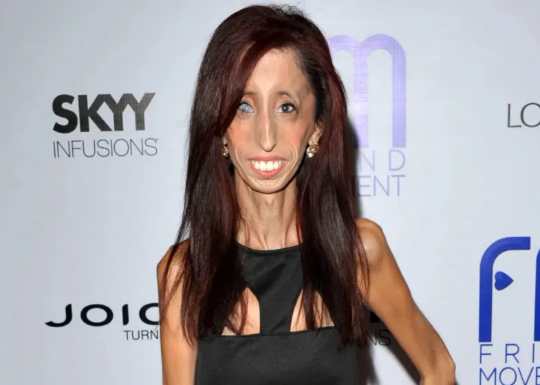 Lizzie Velasquez's Husband, Age, Height, Weight, Net Worth, Career, And More - Bio Scops